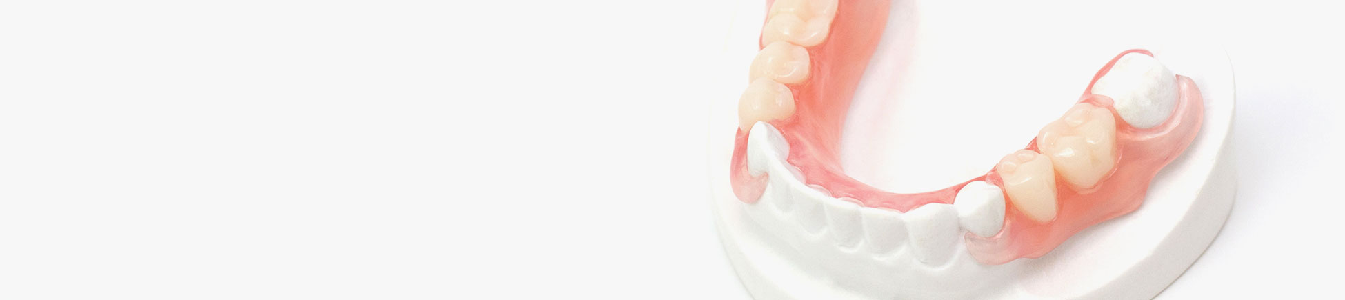 Flexible Dental Partials, Resin Partial Frames, Acrylic Partials | Sun ...